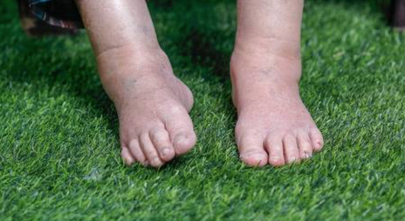 Chronisch Veneuze Insufficiëntie (C.V.I.) l Duidelijke en simpele uitleg