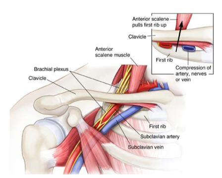 Thoracic outlet syndroom l Oorzaak en behandeling l Deurne