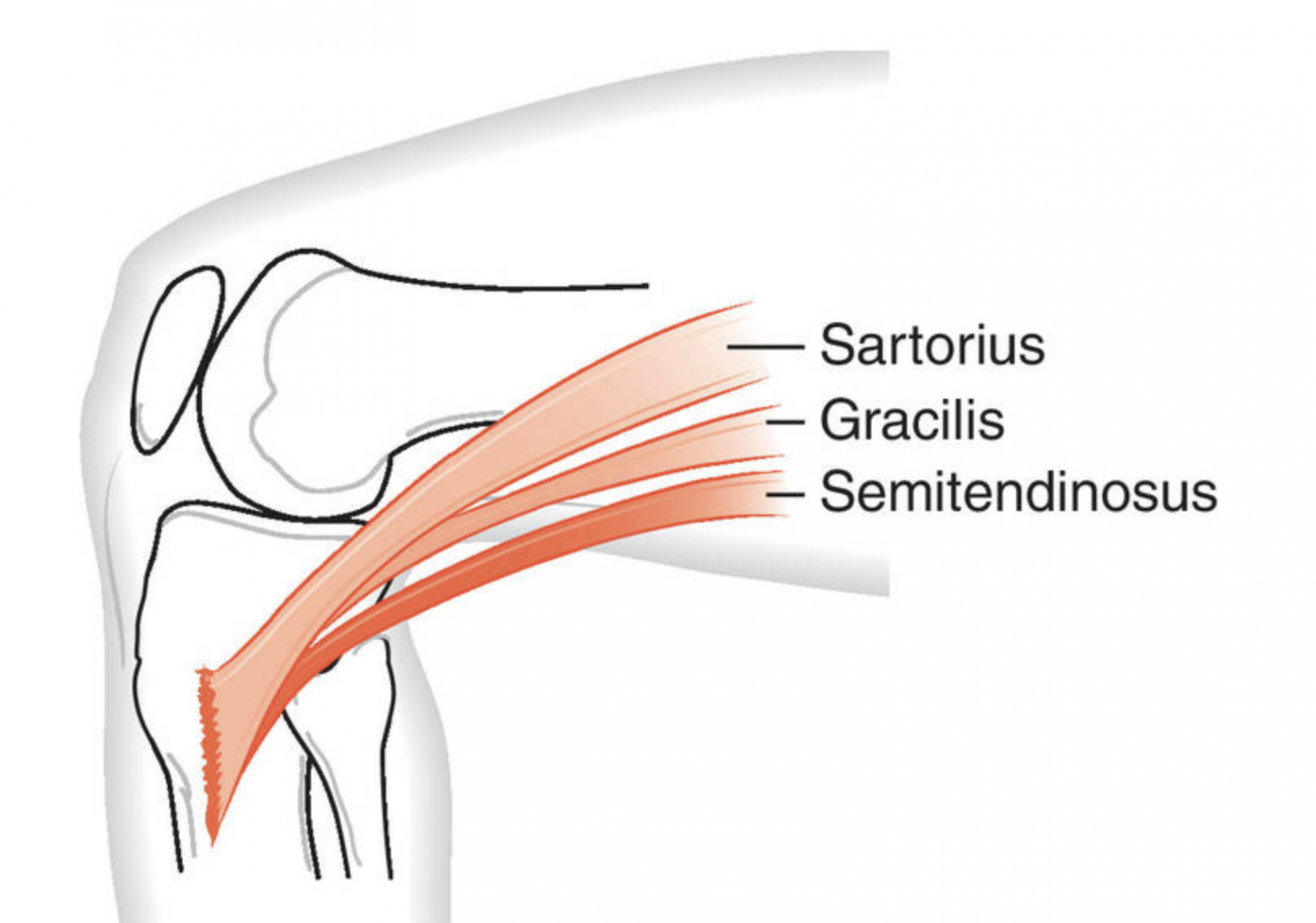 Pes anserinus syndroom | Oorzaak en behandeling | fysio Jansen | Deurne